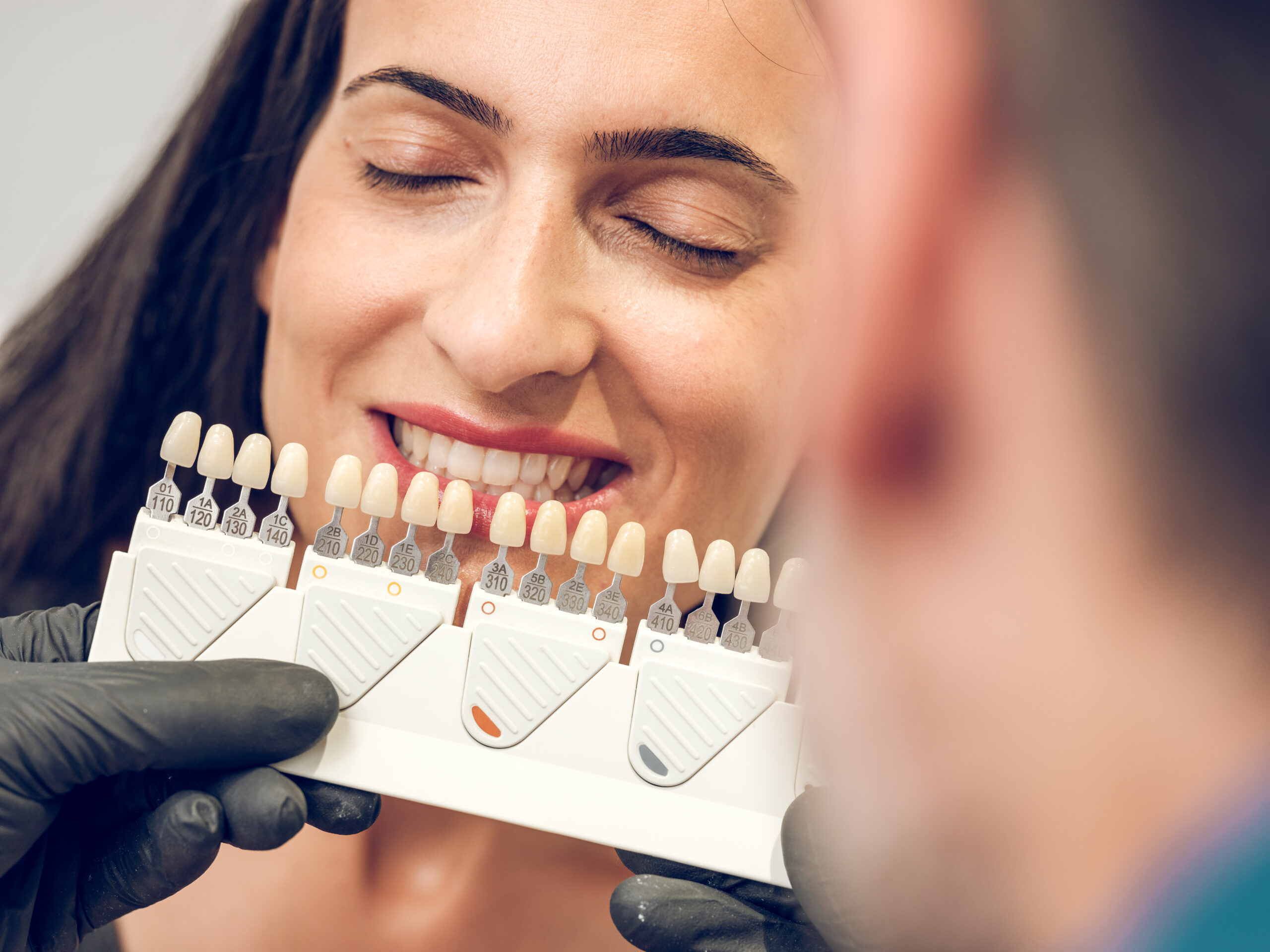 Can You Take Veneers Off? What to Know Before Removing Them